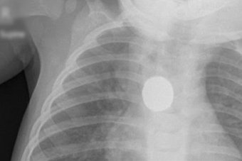 Go Ask Mum New Calls for Tougher Safety Measures on Button Batteries ...