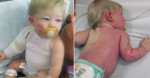 Go Ask Mum Baby is Severely Burned From a Typical Backyard Activity ...
